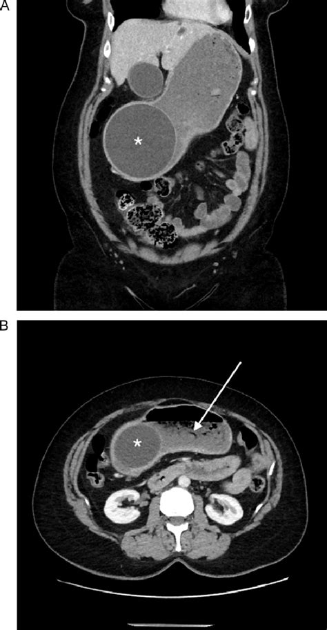 Gastric Balloon Surgery Radiology At Darrell Coria Blog