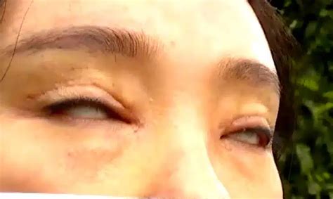 Bruising After Lower Blepharoplasty Recovery Timeline And Photos