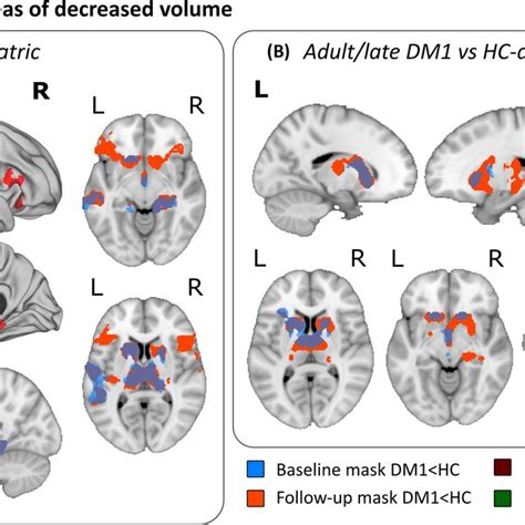 Voxel‐based Morphometry Analyses Showing Significantly Decreased