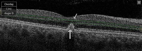 Spectral Domain Optical Coherence Tomography Of Subfoveal Drusenoid Download Scientific Diagram