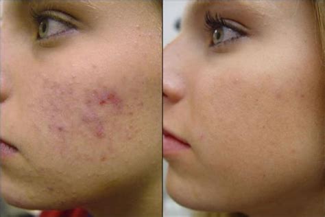 How To Remove Pimple Marks Online Web Site Guide Find All Web Site In One Place