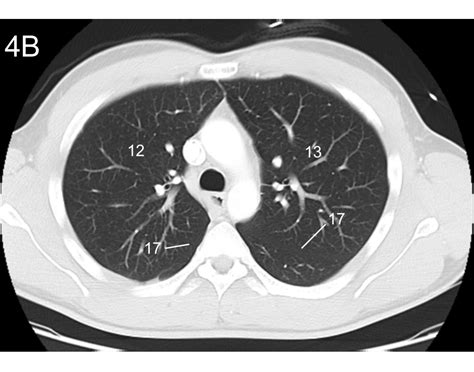 4b Axial Chest Ct Quiz