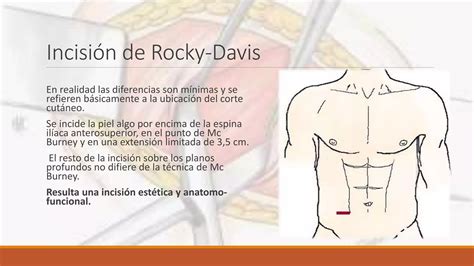 Tratamiento Quirúrgico De Apendicitis Aguda Pptx