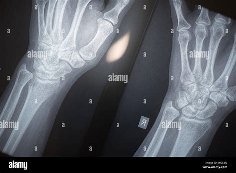 Wrist Bones