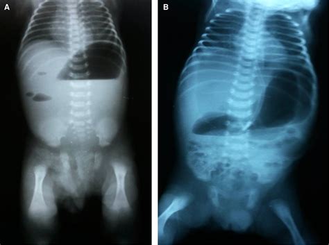 Intestinal Atresia