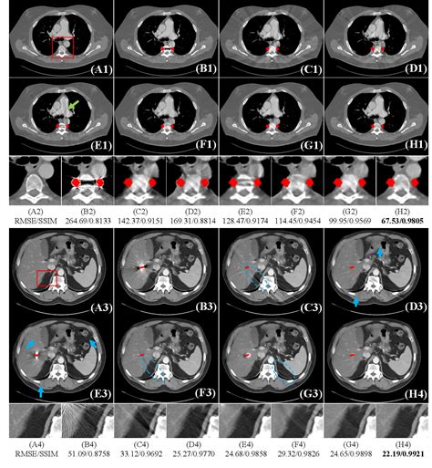 Figure 3 From Deep Sinogram Completion With Image Prior For Metal Artifact Reduction In Ct