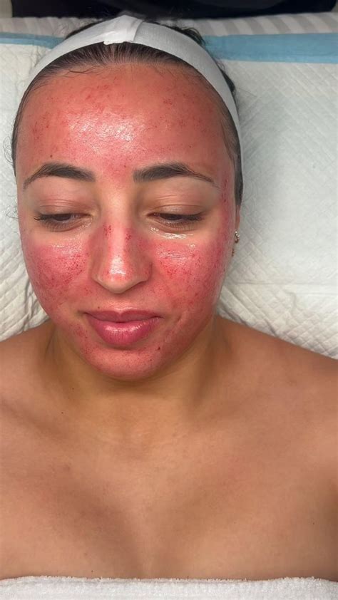 Did You Know You Can Dermapen Lips For That Plump Effect And Eyes To