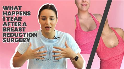After Breast Reduction Surgery Gwrnjd