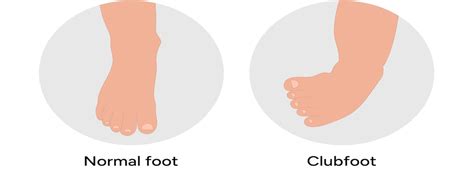 Clubfoot Causes Symptoms Treatments Gleneagles Hospitals Malaysia