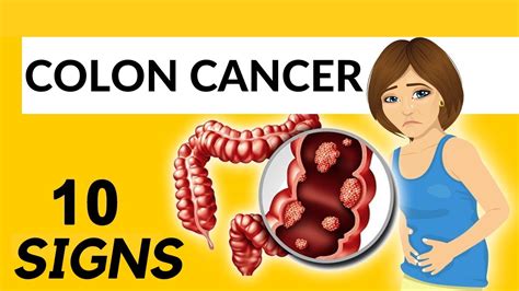 10 Warning Signs Of Colon Cancer You Shouldnt Ignore Do Not Miss The Beginning Youtube