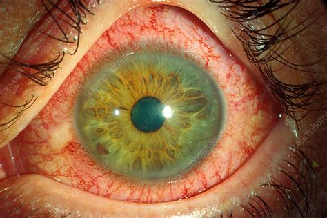 Acute Anterior Uveitis Stock Image C0345826 Science Photo Library