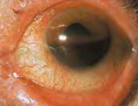 Medical Concept Hyphema Canadiem
