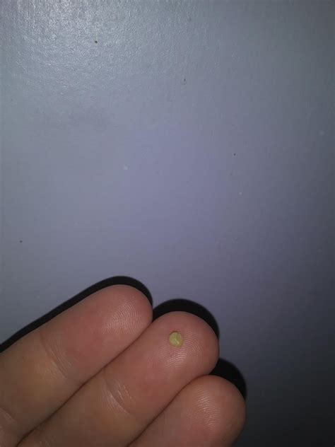 White Dot On Tonsil Like A Pimple Rtonsilstones