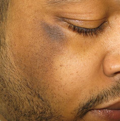 Acanthosis Nigricans Dermatology Advisor