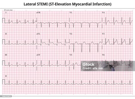 Infark Miokard Elevasi St Lateral 12 Ekg Timbal Kasus Umum 3 Detik