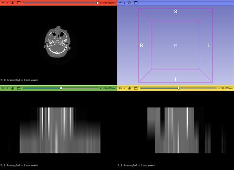 Dicom Files Not Displaying Different Views Properly Support 3d Slicer Community