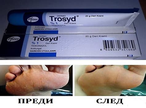 ТРОСИД Trosyd Крем срещу ГЪБИЧКИ по и между пръстите на краката