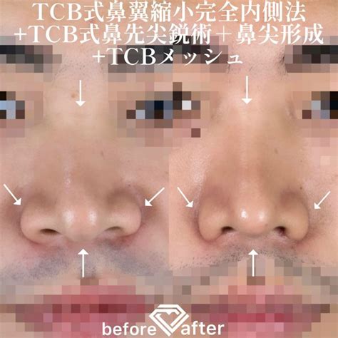 症例写真 ： 美容整形はtcb東京中央美容外科