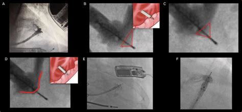 Anchoring Of The Endocardial Electrode Download Scientific Diagram