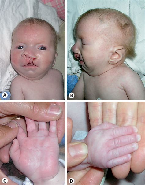 Trisomy 21 Newborn