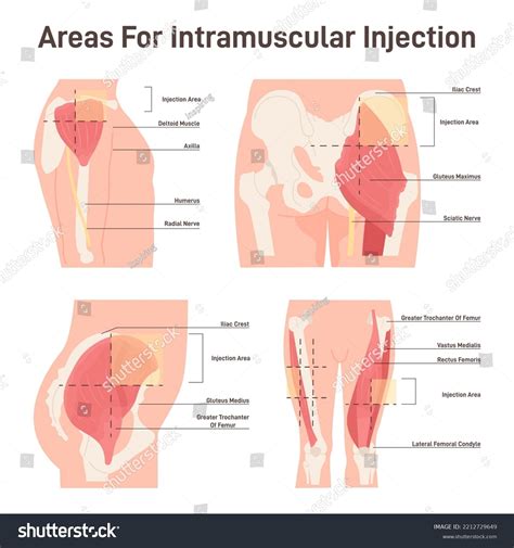 Intravenous Injection Sites