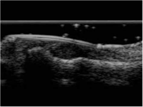 Musculoskeletal Joints And Tendons 64 Fingers Case 645 Tumors Ultrasound Cases