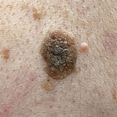 Skin Lesion Removal The Clinical Beauty Room