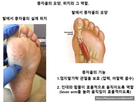 엄지발가락 바닥이 아파요 서있거나 까치발 들때 아파요 엄지의 종자골염은 무엇이고 어떻게 치료하나요 족부정형외과 전문의 김지범 네이버 블로그