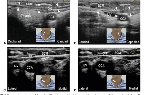 Ultrasound Guided Injection Of Botulinum Toxin In A Patient With