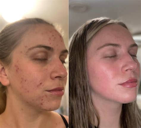 Doxycycline Vibramycin Nurx™