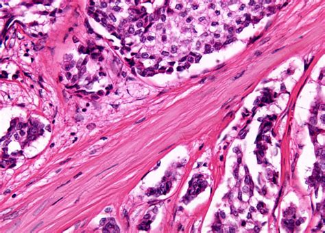 Lymph Node Metastatic Carcinoma At 20x Magnification Nikon S Microscopyu