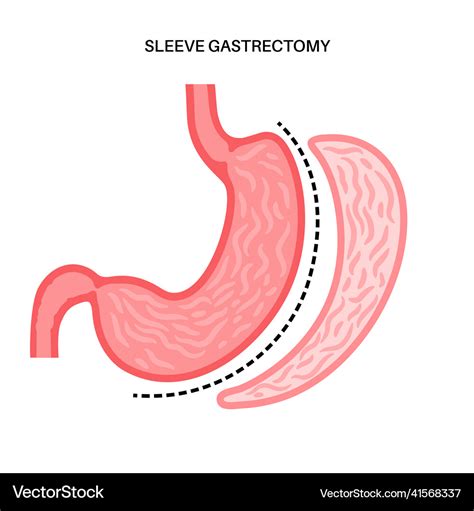 Laparoscopic Sleeve Gastrectomy Anatomy Royalty Free Vector