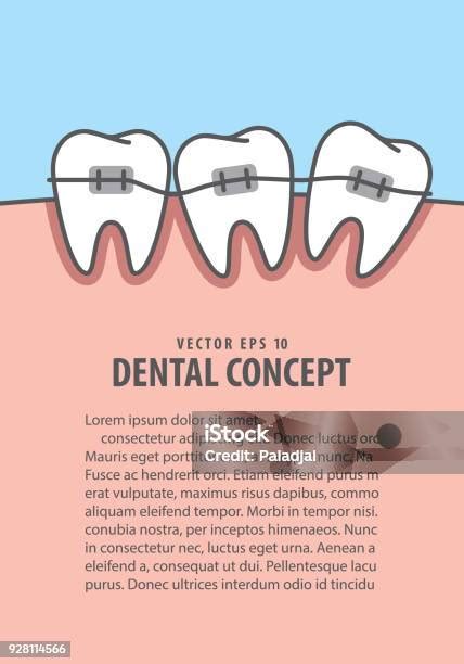 파란색 배경에 레이아웃 교정기 치아 일러스트 벡터입니다 치과 개념입니다 치아교정기에 대한 스톡 벡터 아트 및 기타 이미지 치아교정기 가득 찬 개념 Istock