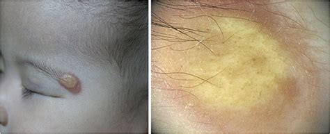 Frontiers Dermoscopic Patterns In Juvenile Xanthogranuloma Based On