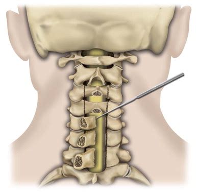 Cervical Laminoplasty Neupsy Key