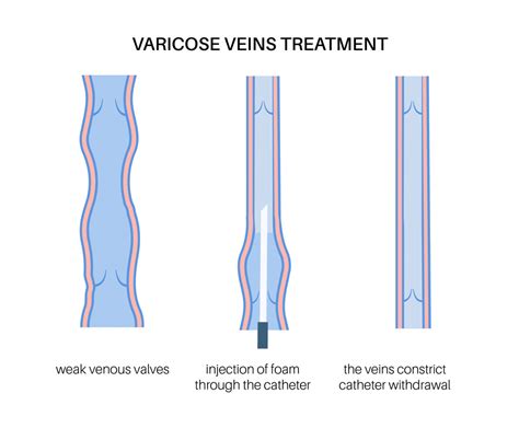 What Can You Expect After Vein Ablation