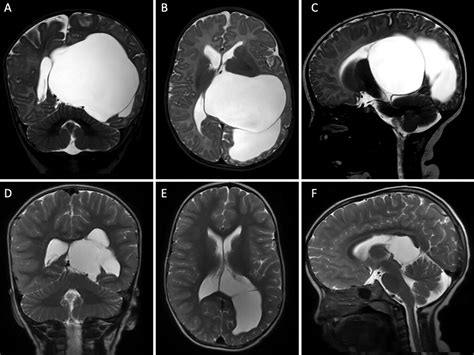 Quadrigeminal Cistern Cyst Endoscopic Management Of Periventricular