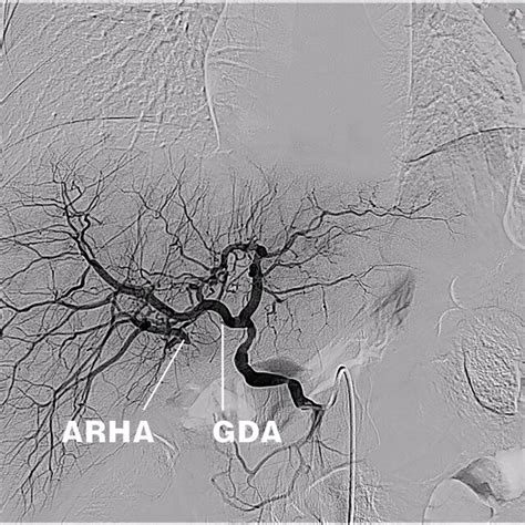 Michels Classification Of The Hepatic Arteries Download Table