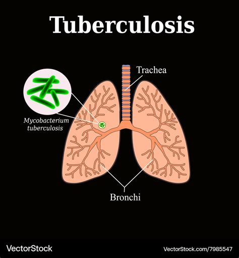 Tuberculosis Lung Disease Tubercle Bacillus Vector Image
