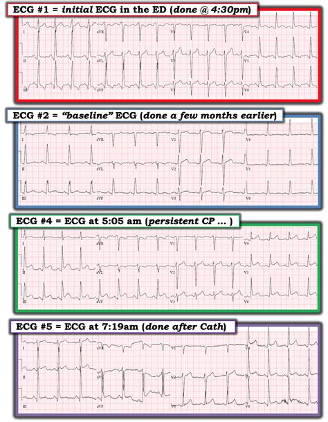 Ivcd Ecg Images Gertykorea