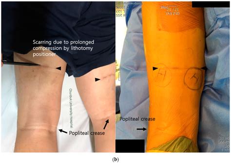 Open Sciatic Nerve Decompression For Compartment Syndrome After