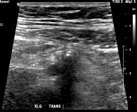 Acute Appendicitis Radiology Case Collection
