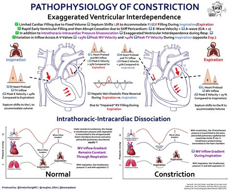 Constrictive Pericarditis Pathology