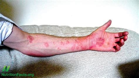 Meat Allergy Due To Tick Bite At Mabel Singer Blog