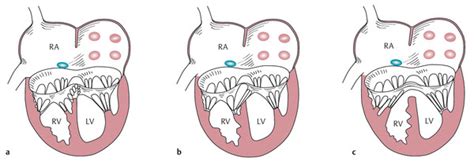 15 Congenital Heart Defects Thoracic Key