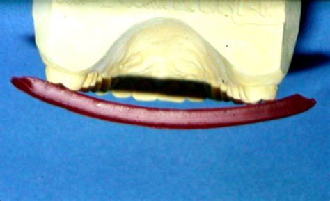 Lecture 8 Static Factors Of Occlusion Inter And Intra Arch Factors