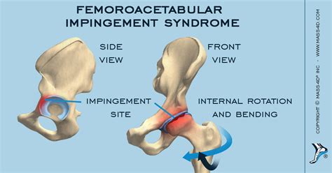 Cam Type Femoroacetabular Impingement Morphology At James Goldsbrough Blog