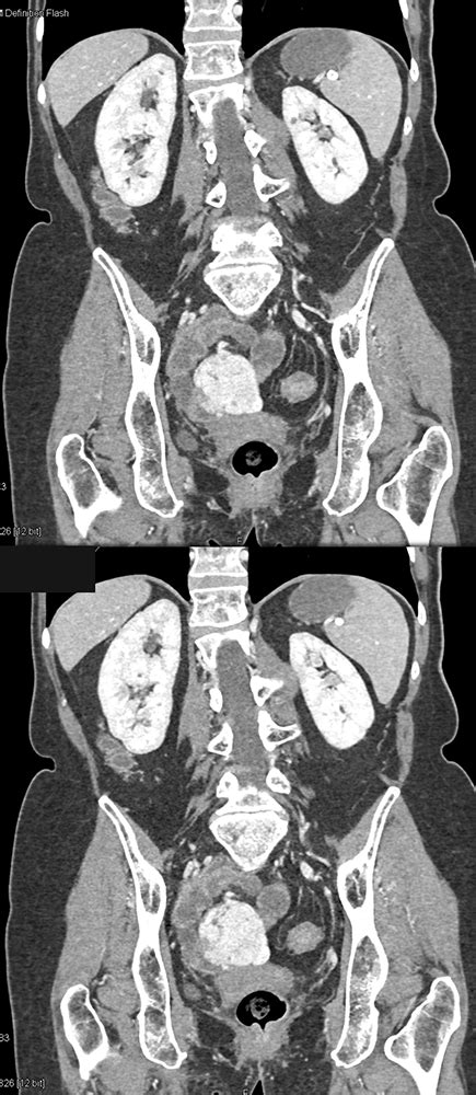 Gastrointestinal Learning Modules Ct Scanning