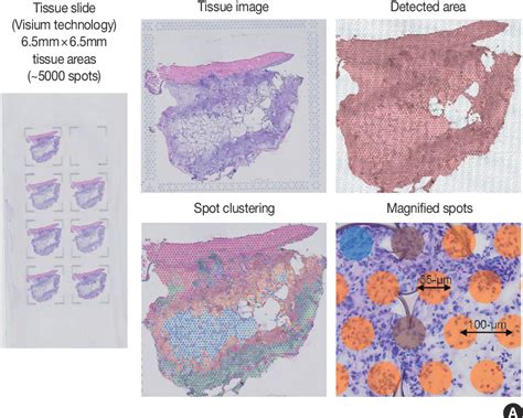 Figure 2 From Single Cell And Spatial Sequencing Application In Pathology Semantic Scholar