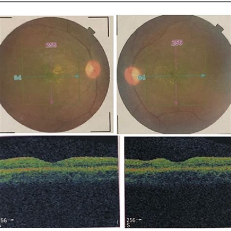 The Macular Oct Showing Exudates In The Plexiform Layer Of The Left